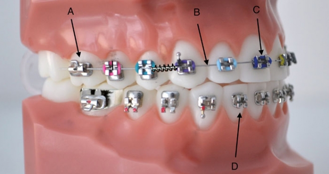 Parts of braces